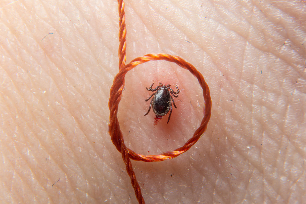 Maladie de Lyme - Comment enlever la tique? - Vidya-Shop